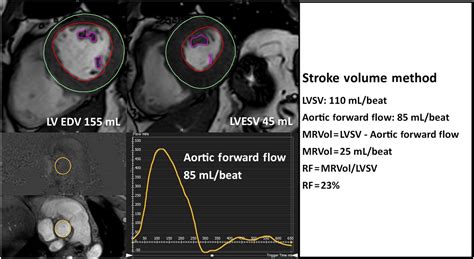 Quantitation Of Mitral Regurgitation With Cardiac Magnetic Resonance