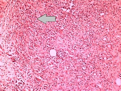 Figure 4 From Healing Of Ischemic Colon Anastomosis In Rats Could Be