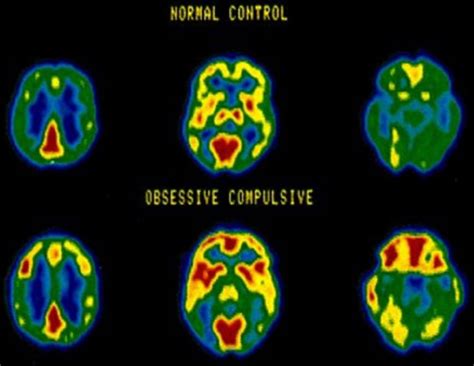 Understanding Ocd Brain Differences