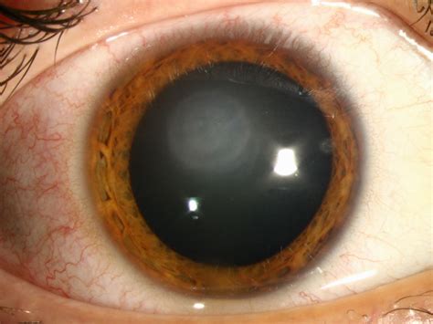 Atlas Entry Hsv Disciform Keratitis