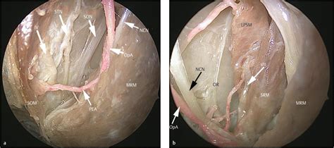 14 Orbital Decompression Optic Decompression Supraorbital Approach