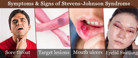 Steven Johnson Syndrome