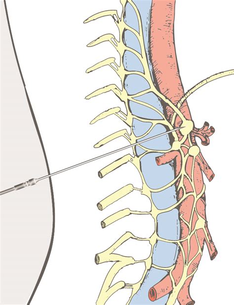 Coeliac Plexus Block Brisbane Rehab