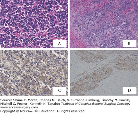 Ectopic Acth Syndrome Oncohema Key