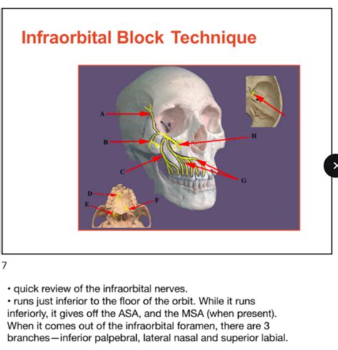 Maxillary Anesthesia Techniques Of Administration Flashcards Quizlet