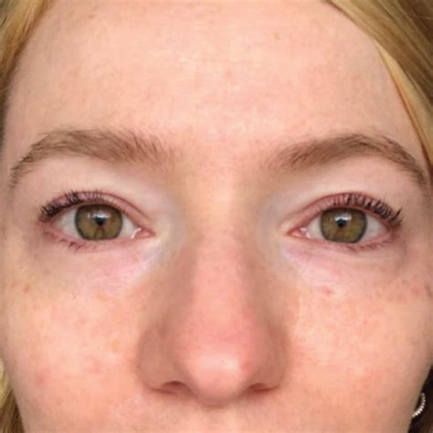 Prf Under Eye Treatment Melbourne Plasma Therapy