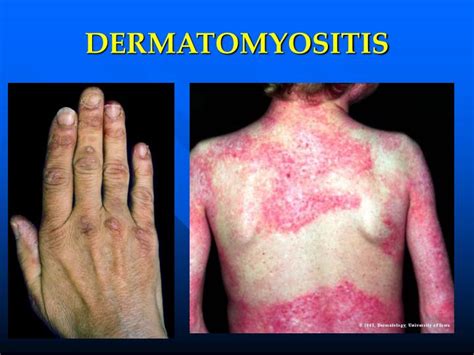 Ppt Dermatological Manifestations Of Systemic Disease Powerpoint