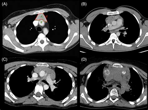 Thymic Hyperplasia Cancer At Mike Fahey Blog
