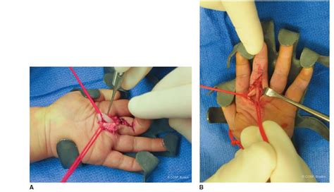 Trigger Digits Obgyn Key