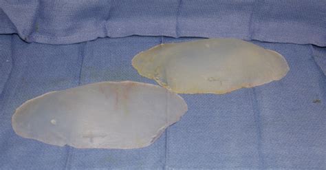 Plastic Surgery Case Study Custom Forehead Temporal Head Widening