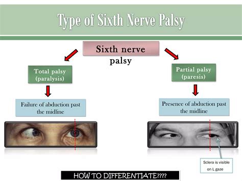 Sixth Nerve Palsy