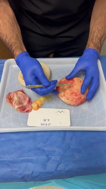 This Patient Recently Had 15 Year Old 350cc Polyurethane Silicone