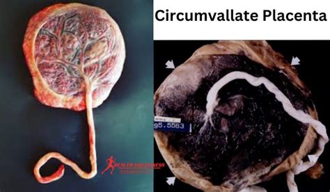 5 Inredible Facts About Circumvallate Placenta Cause Treatment Risks
