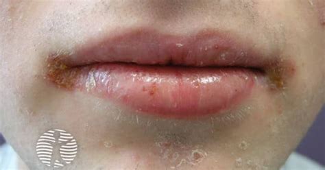 Angular Cheilitis Image