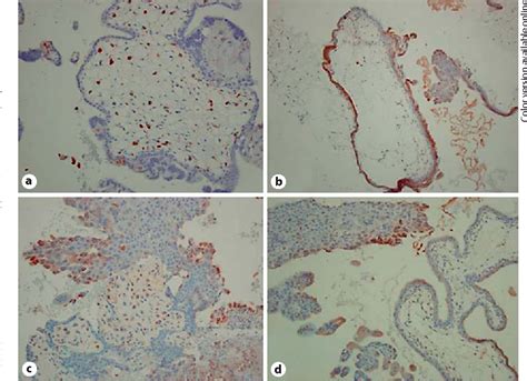 Figure 1 from Analysis of RCAS1 Immunoreactivity within Hydatidiform Mole Cells and Decidual ...