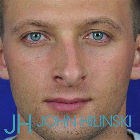Crooked Nose On A Guy Rhinoplasty Cost Pics Reviews Qanda