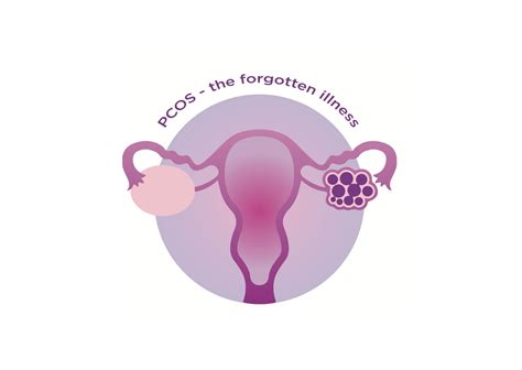 Is Pcos A Forgotten Illness