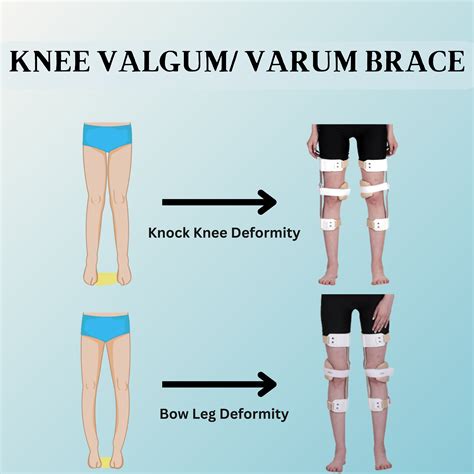 Buy Salo Orthotics Knock Knee And Bow Leg Brace Genu Valgum Genu Varum