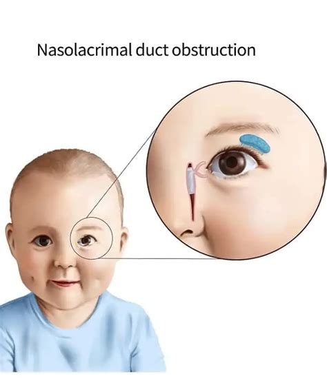 Nasolacrimal Duct Clogged Tear Duct Rnewborns