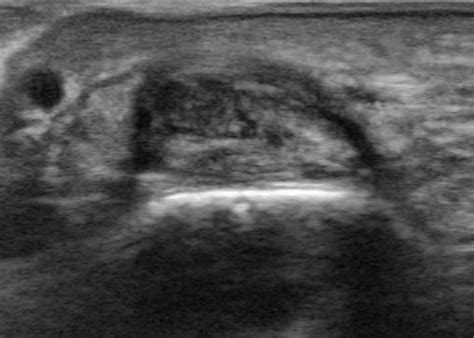Musculoskeletal Joints And Tendons 6 8 Foot Case 6 8 3 Tendon Pathology Ultrasound Cases