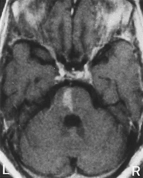 Paramedian Pontine Infarction Stroke