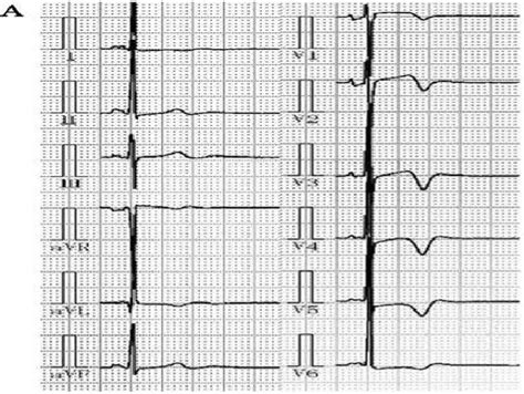 Ecg Showing High Voltage Qrs Complexes Impaired St Segments And T Wave