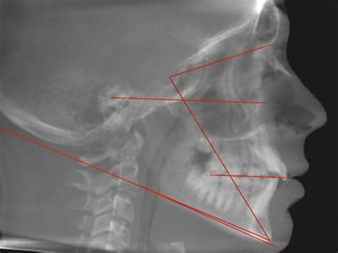 How A Discrepancy Between Centric Relation And Maximum Intercuspation