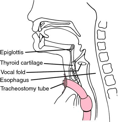 Jaxsons Fight A Trach Post