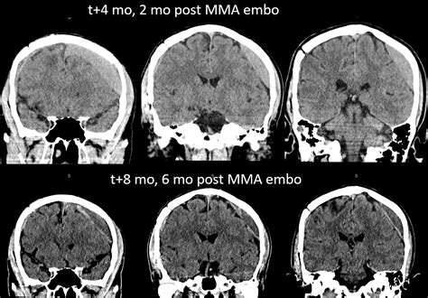 Subdural Hematoma Embolization