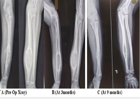 Ossification Of A Distal 1 3rd Ulnar Shaft Abc Tumor Abc Aneurysmal Download Scientific