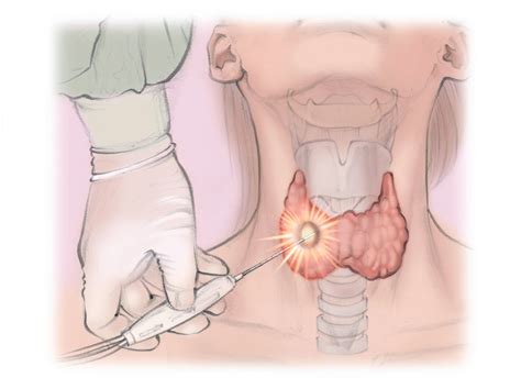 Thyroid Ablation — The Interventional Initiative