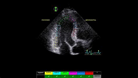 C Third Global Longitudinal Strain Starting With Segmental Strain Download Scientific