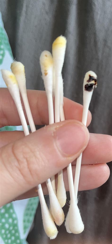 My Daughter Had A Burst Ear Drum A Couple Of Months Agol Had To Wait