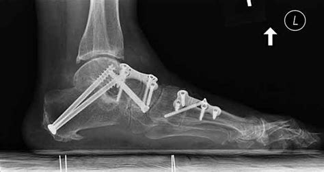 Ankle And Hindfoot Fusion Arthrodesis Cllc Montréal Dre Marie