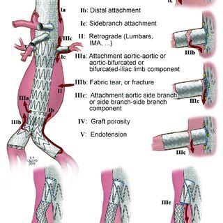 Classification Of Endoleaks Of Fenestrated Branched Endovascular Aortic