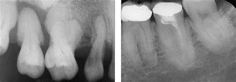 Hypercementosis Anomalies Of The Tooth Ce651
