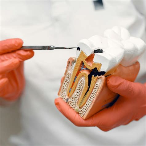 Tooth Decay Causes And Treatments Yorkshire Dental Suite