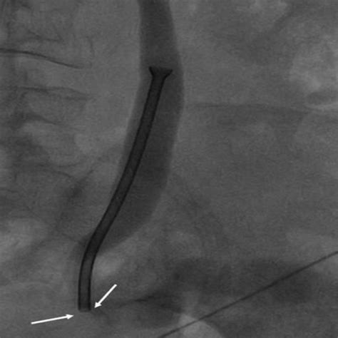 Right Nephrostogram Showing A Memokath 051 Stent In A Dilated Ureter