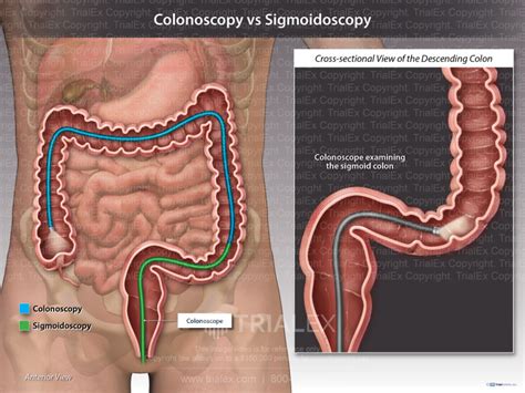 Sigmoidoscopy