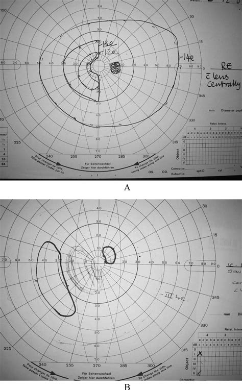 Case 2 A Right Goldmann Visual Field Showing Temporal Loss And B Download Scientific