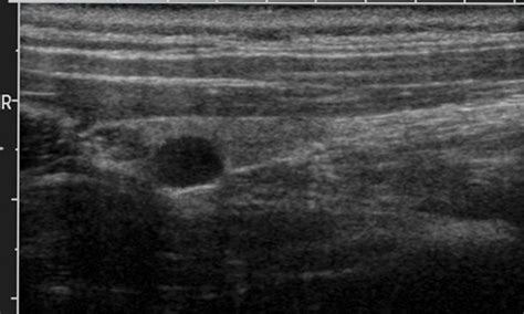Primary Hyperparathyroidism