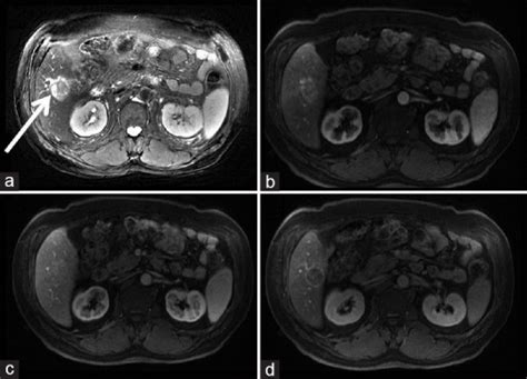 A Case Of Hepatic Focal Nodular Hyperplasia Mimicking Hepatocellular