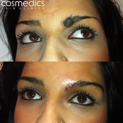 Mole Removal Clinics London And Bristol Cosmedics Skin Clinics