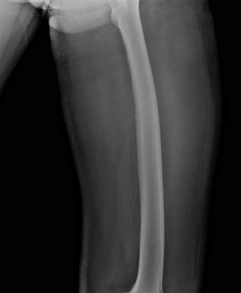 Hematoma Intramuscular Causas Y Tratamiento Efisio Fisioterapia Madrid