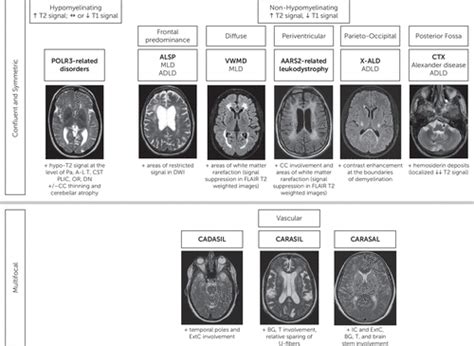Diagnosis Prognosis And Treatment Of Leukodystrophies The 55 Off