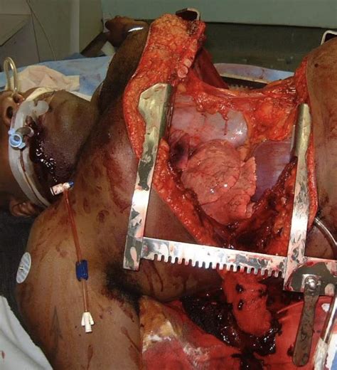 Emergency Bilateral Thoracotomy Clamshell For Gunshot To Chest R