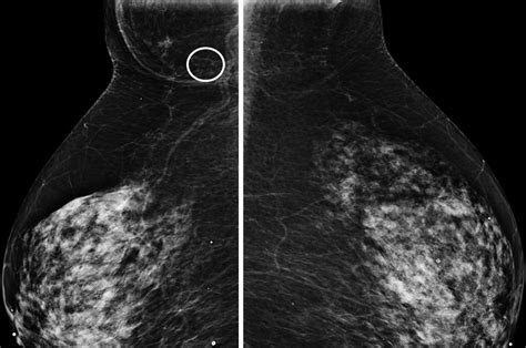 Bilateral Accessory Breast