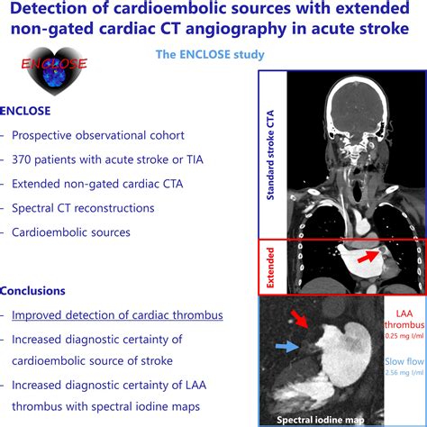 Detection Of Cardioembolic Sources With Nongated Cardiac Computed