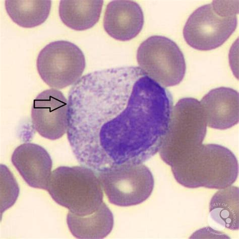 Fun Quiz Hematology Cell Identification The Mislabeled Specimen Fun