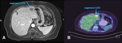 Liver Lesions MRI